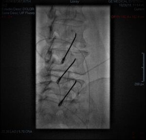Rizolisis lumbar y cervical por radiofrecuencia